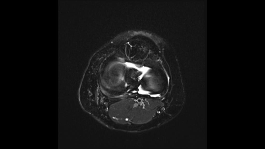 Tx/Rx Knee 15 Flare Coil - Siemens Healthineers