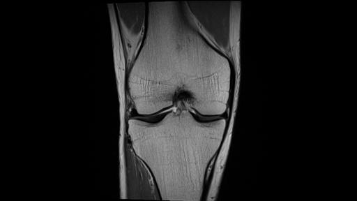 Tx/Rx Knee 15 Flare Coil - Siemens Healthineers