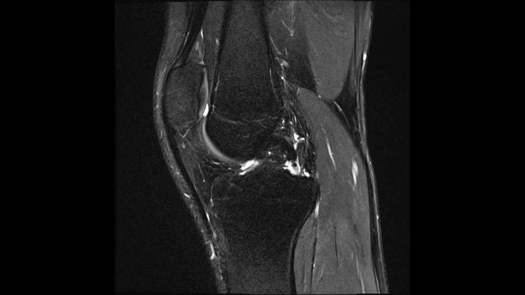 Tx/Rx Knee 15 Flare Coil