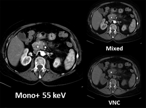 What is Dual Source Dual Energy? - Siemens Healthineers USA