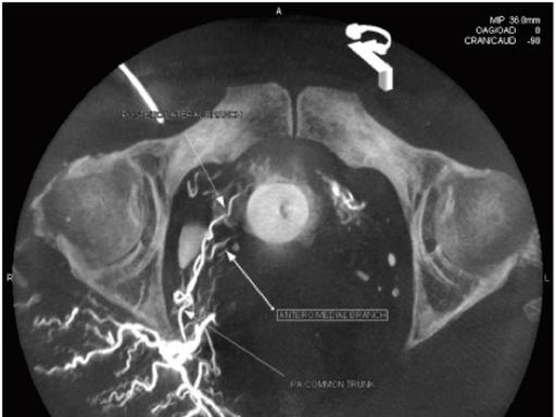 Prostate Artery Embolization - Siemens Healthineers Vietnam