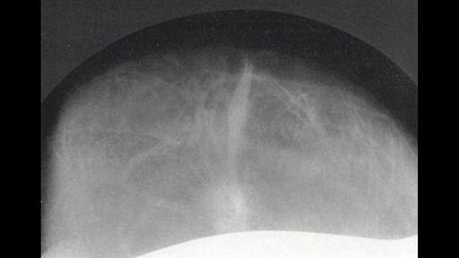 Siemens Healthineers history in mammography