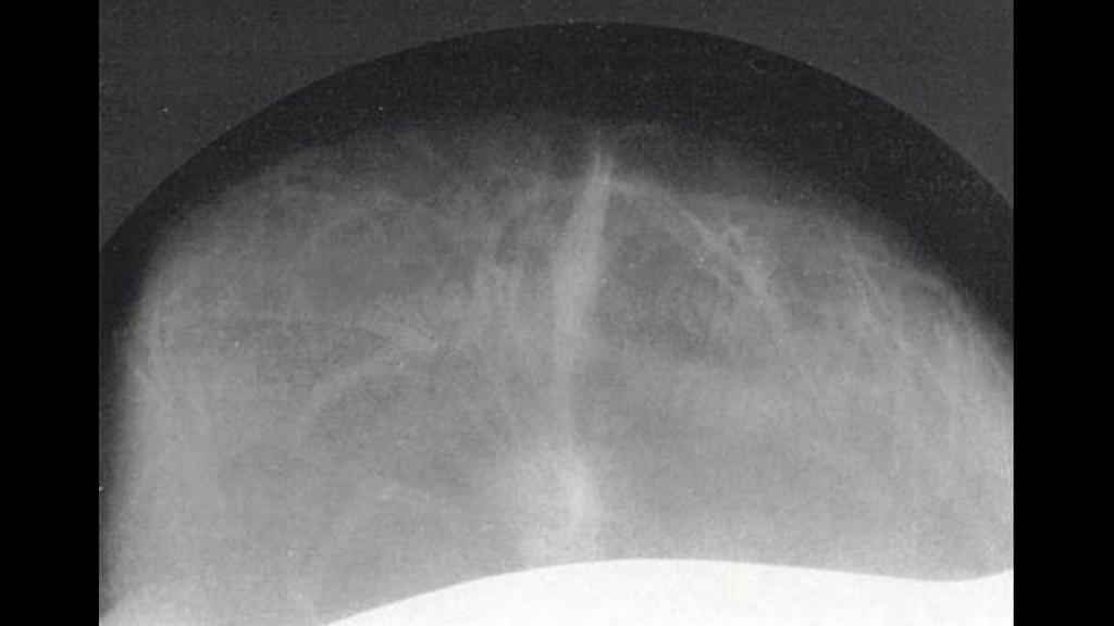 Siemens Healthineers history in mammography