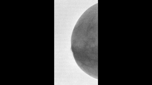 Siemens Healthineers history in mammography