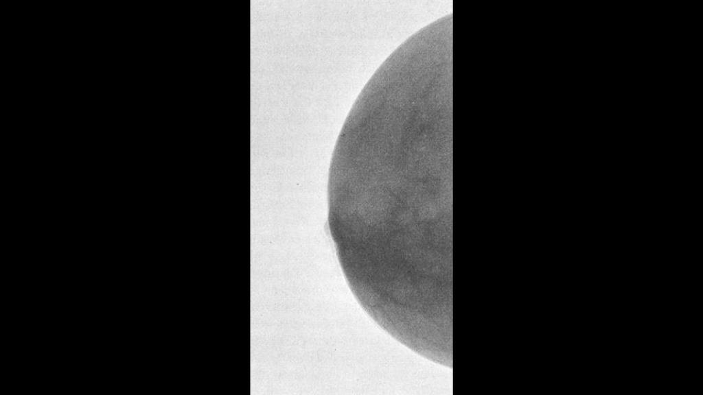 Siemens Healthineers history in mammography - Siemens Healthineers