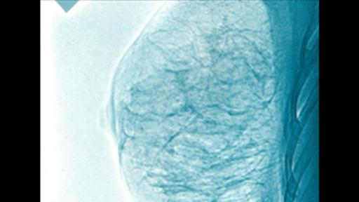 History of mammography: - Siemens Healthineers