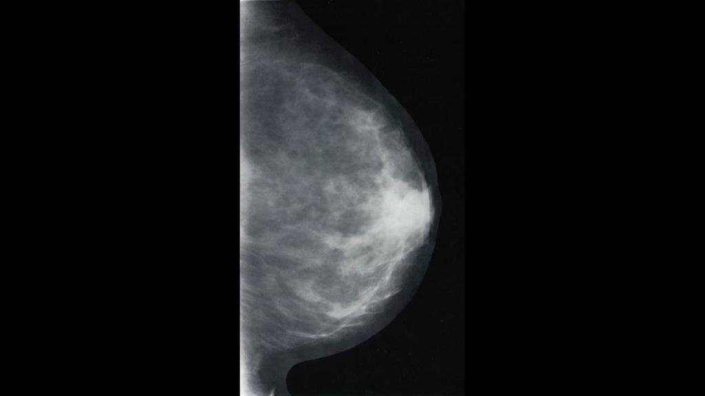 History of mammography: