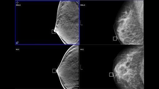 How can tomo reading be further optimized? - Siemens Healthineers