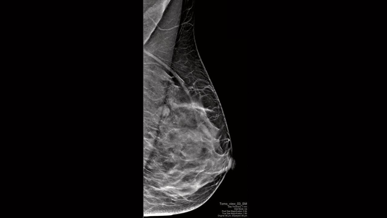 A more recent approach to reduce dose: synthetic mammograms - Siemens ...