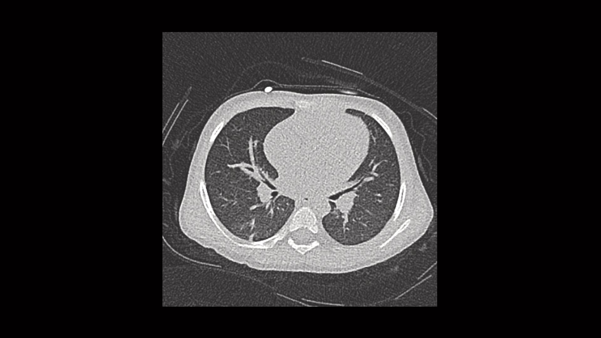 CT Scanner - SOMATOM Force - Siemens Healthineers