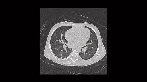 CT Scanner - SOMATOM Force - Siemens Healthineers