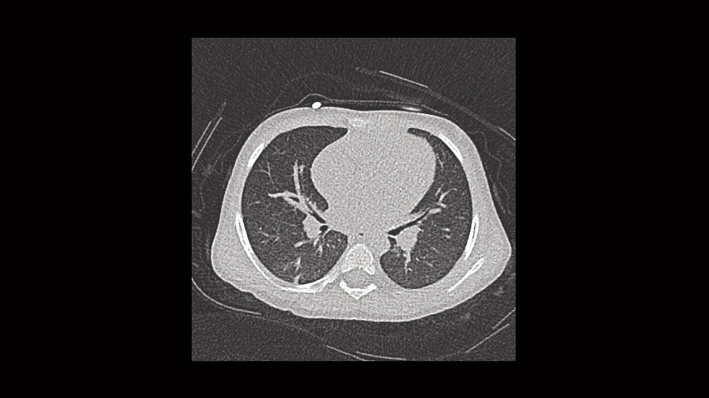 CT Scanner - SOMATOM Force - Siemens Healthineers Latinoamérica