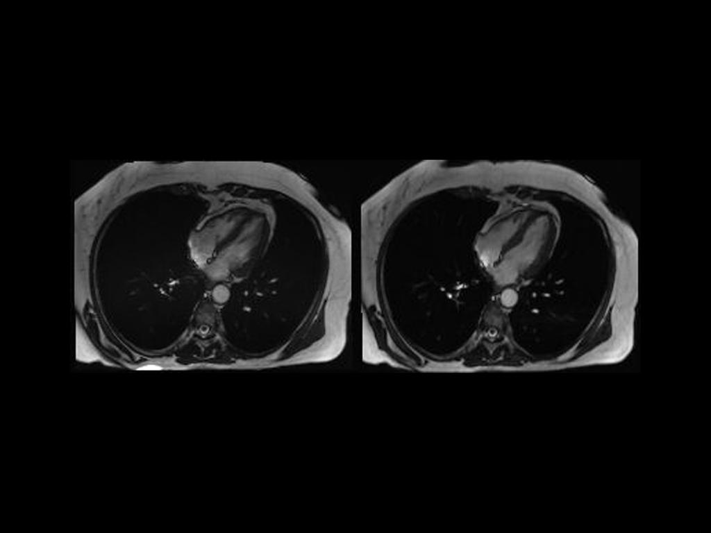 Faster MRI scans with Compressed Sensing from Siemens Healthineers ...