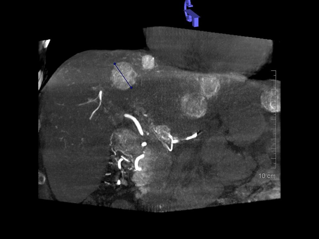Cross sectional cone beam CT image indicating the liver tumor nodule to ...