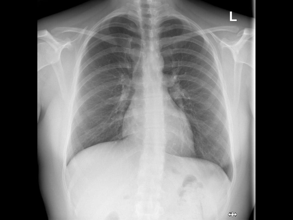 Lung image using Multitom Rax - Siemens Healthineers Bulgaria