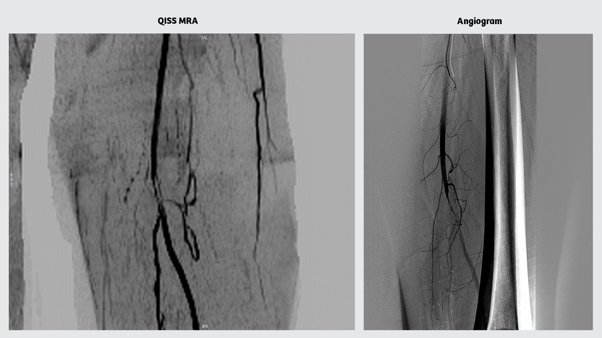 High-quality, non-contrast MRA for Peripheral Artery Disease (PAD ...