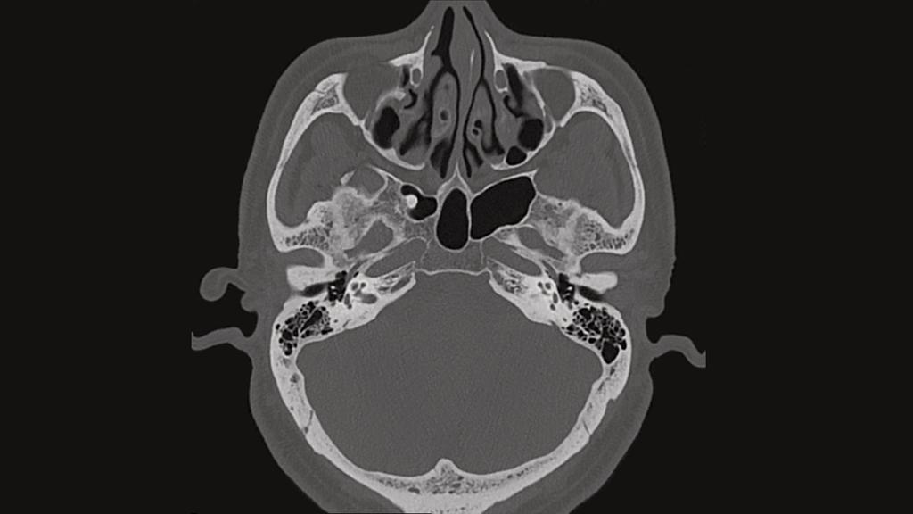 SOMATOM go.Now - Siemens Healthineers España