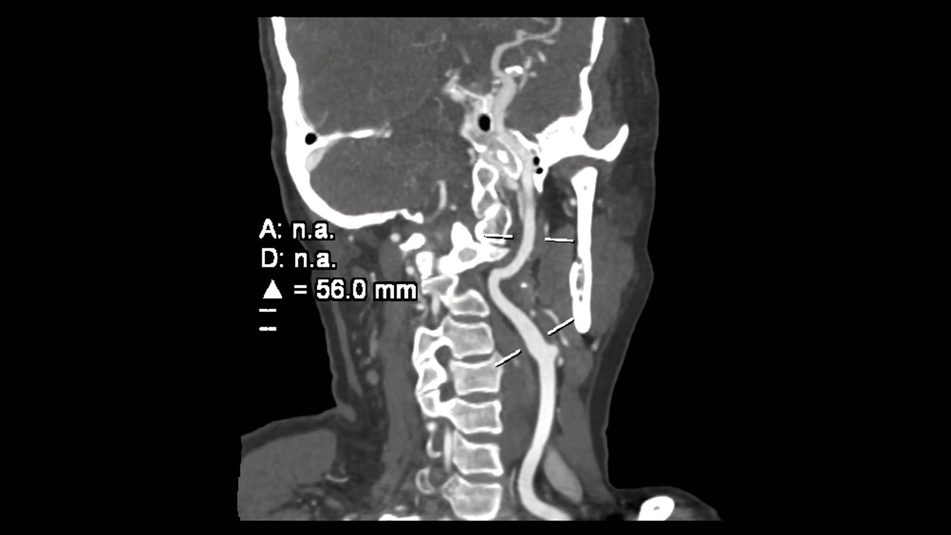 SOMATOM go.Now - Siemens Healthineers España