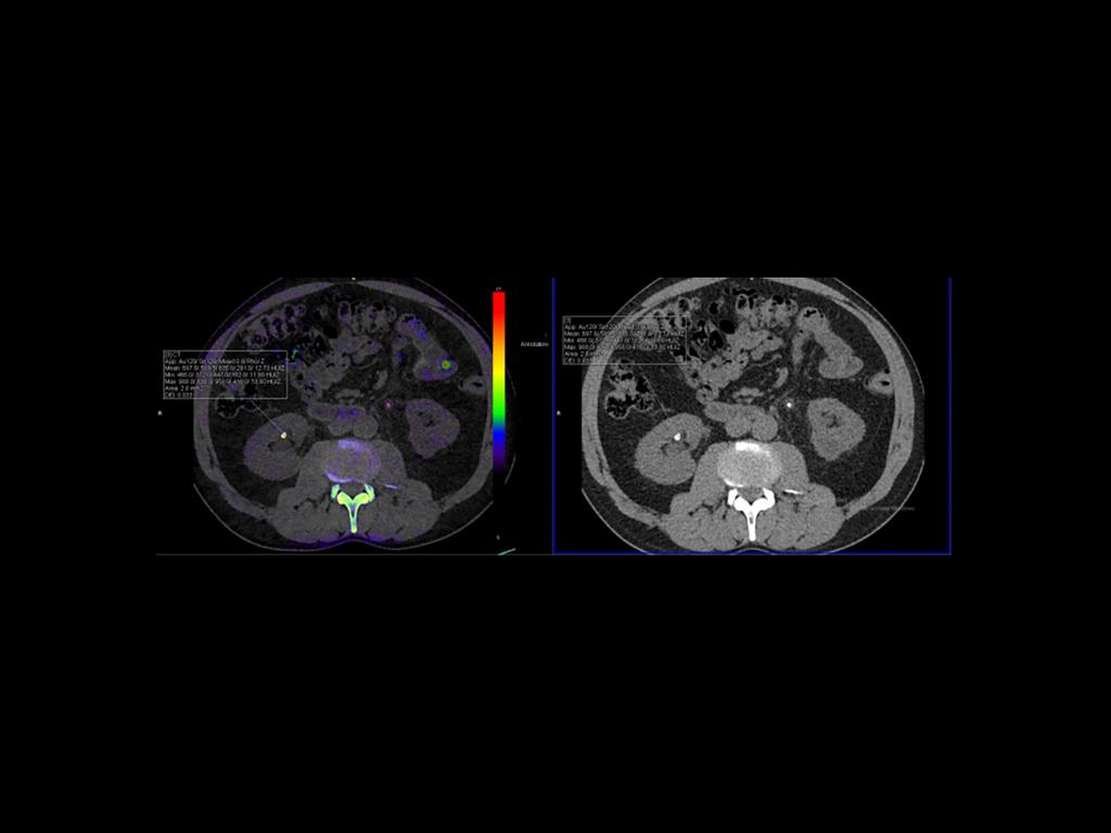 TwinBeam Dual Energy - Siemens Healthineers USA