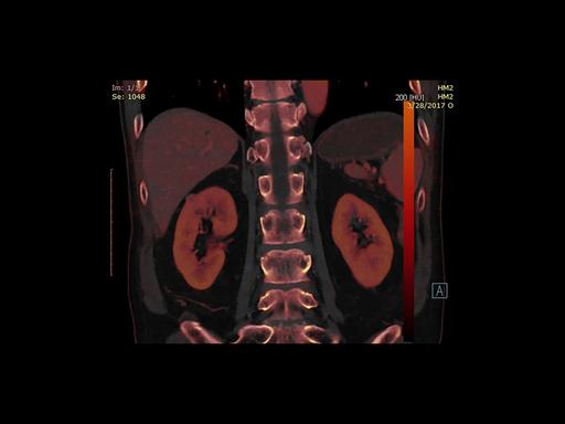 TwinBeam Dual Energy - Siemens Healthineers USA