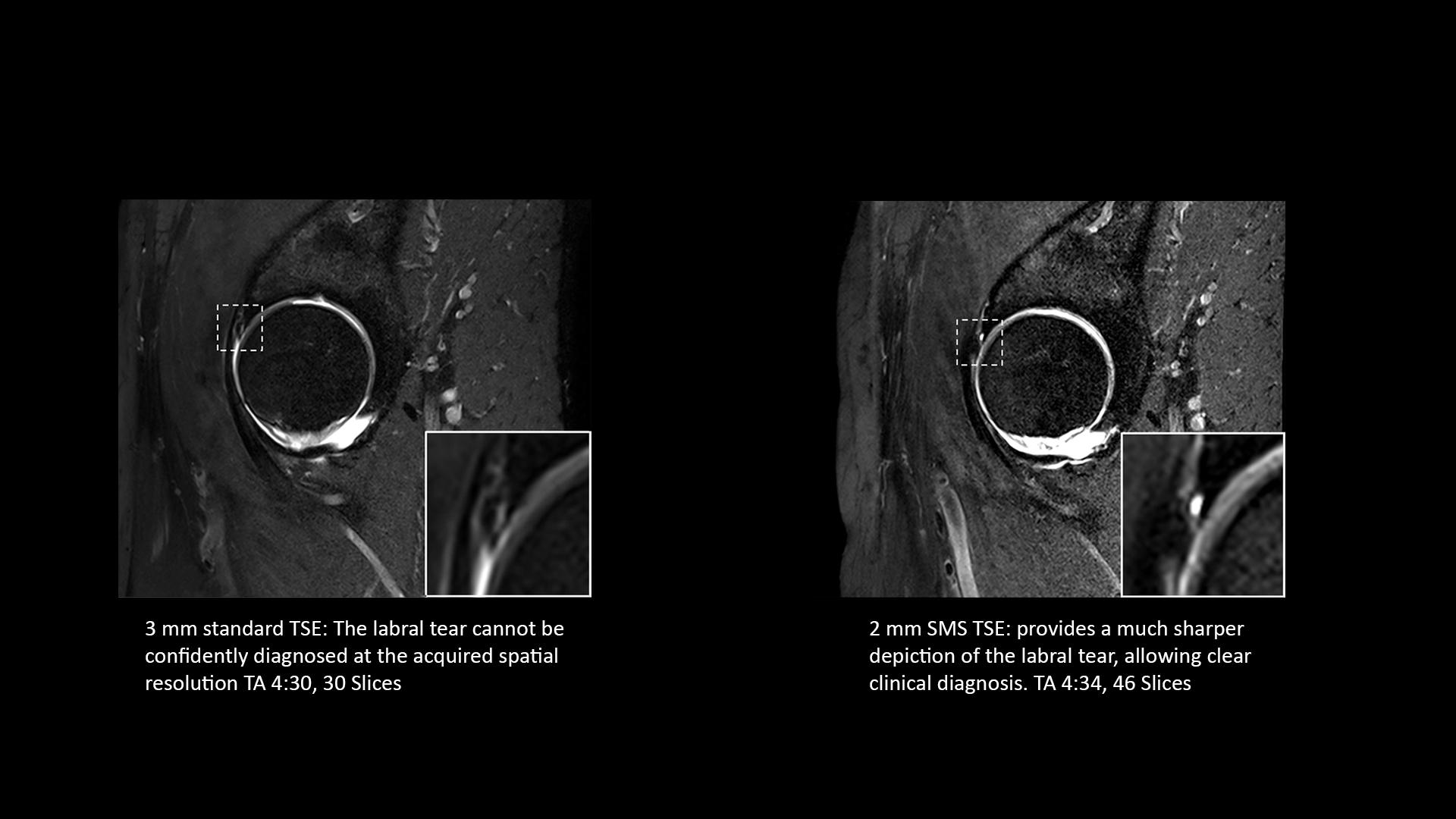 Simultaneous Multi-Slice - Siemens Healthineers
