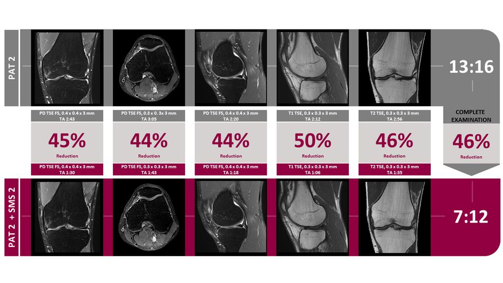 Simultaneous Multi-Slice - Siemens Healthineers