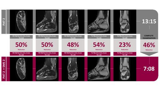 Simultaneous Multi-Slice - Siemens Healthineers