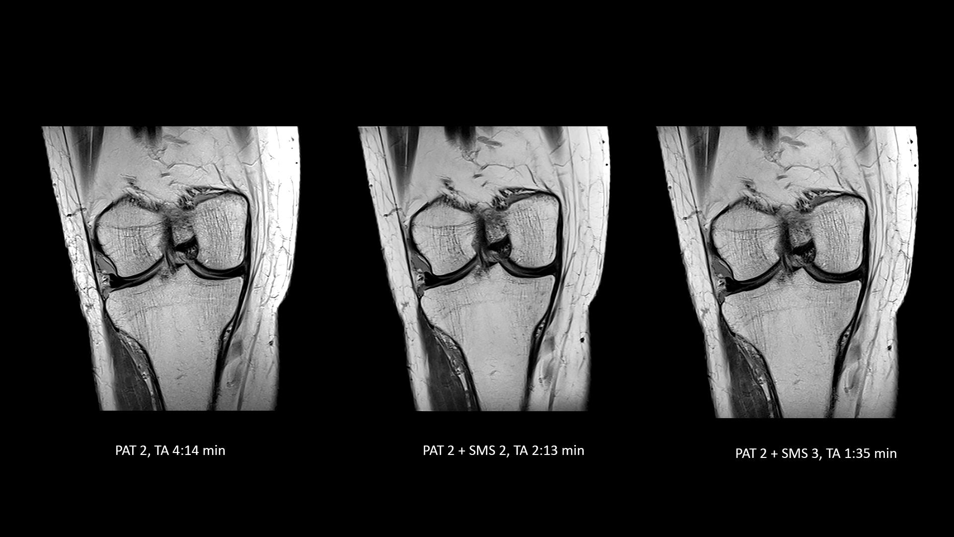 Simultaneous Multi-Slice - Siemens Healthineers