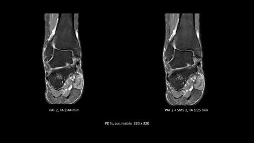 Simultaneous Multi-Slice - Siemens Healthineers