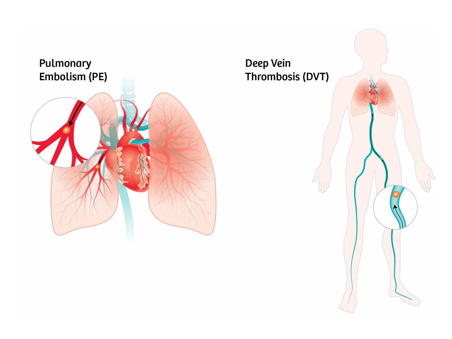 D dimer Testing An Essential Element In Pulmonary Embolism And Deep