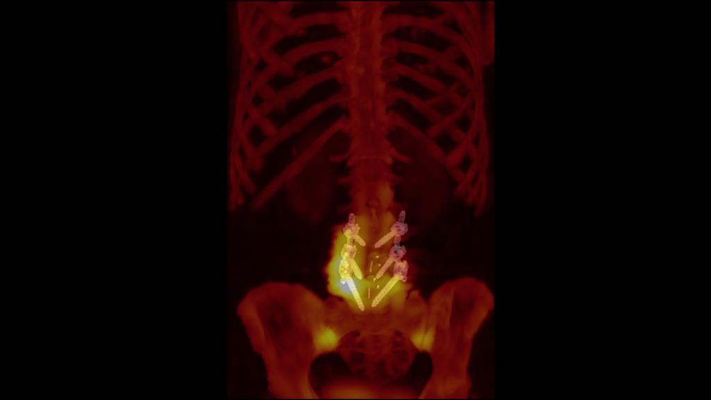 xSPECT Bone - Siemens Healthineers