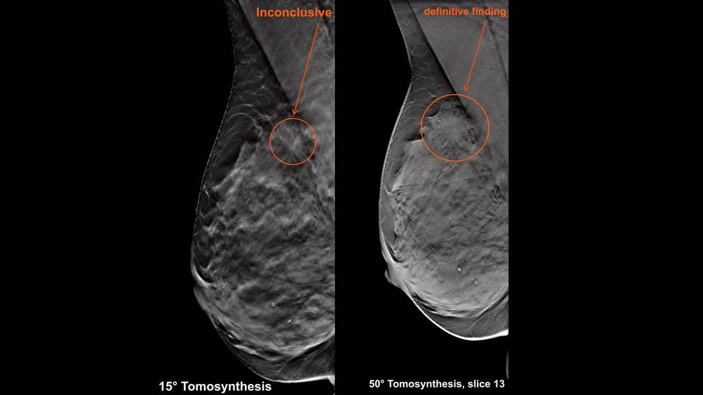 Tomosynthesis and Contrast-Enhanced Mammography Improve Cancer Detection