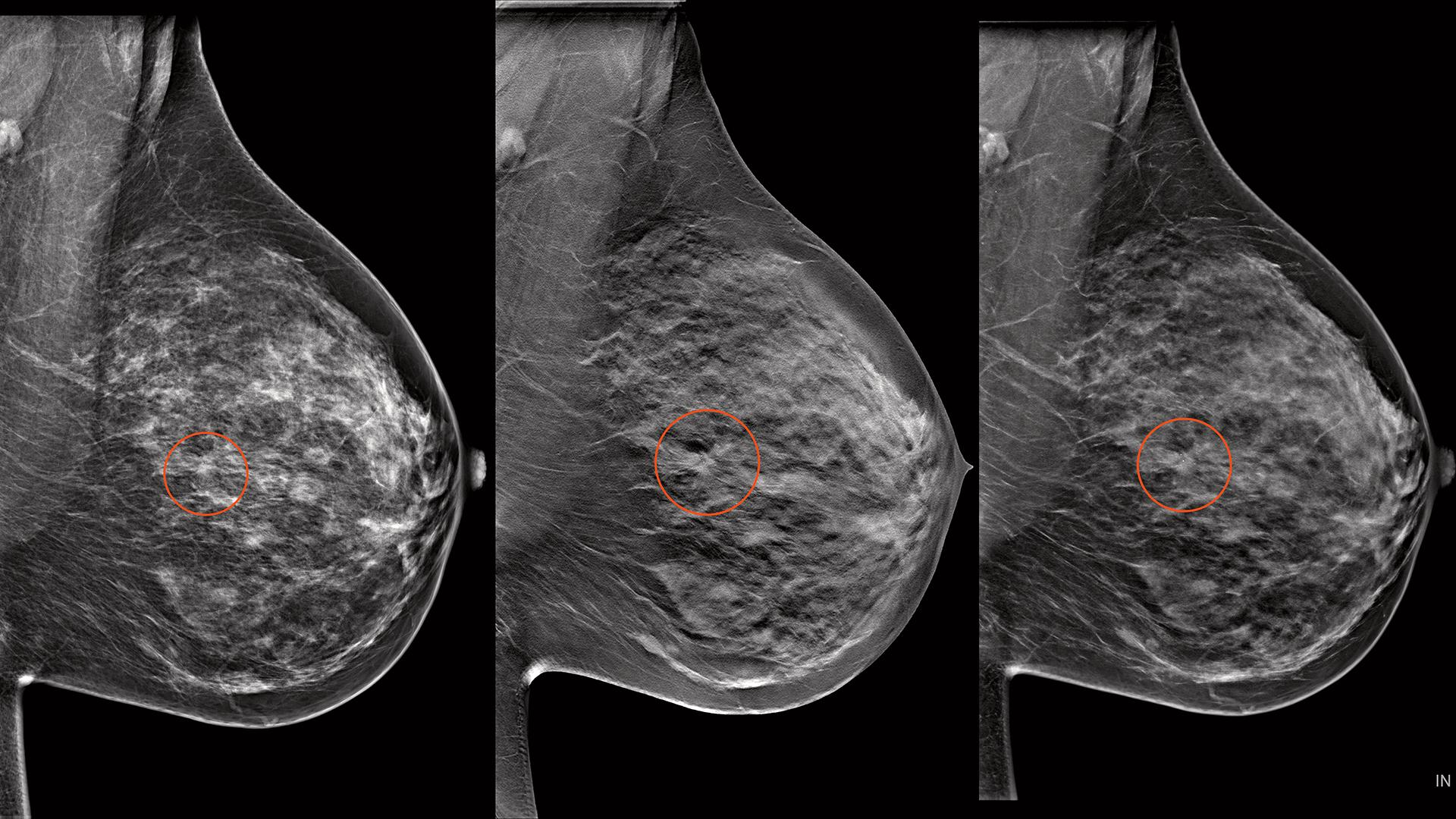 Tomosynthesis and Contrast-Enhanced Mammography Improve Cancer Detection