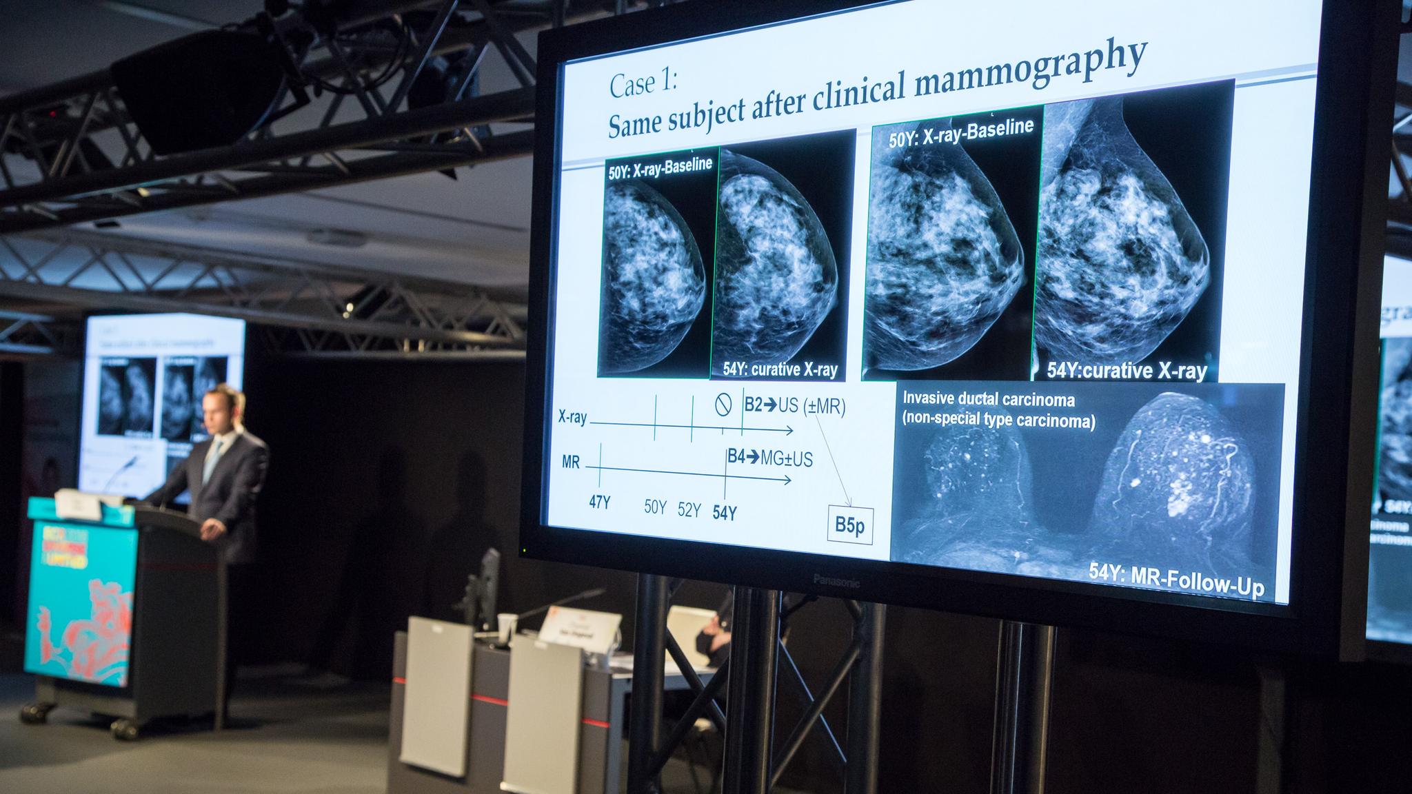 Tomosynthesis and Contrast-Enhanced Mammography Improve Cancer Detection