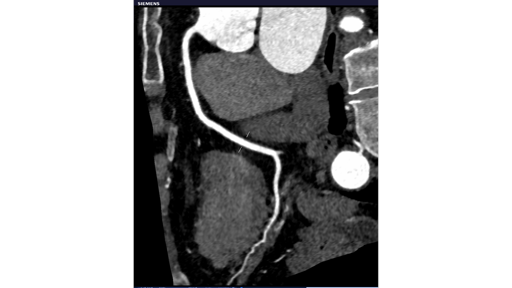 Coronary CTA at Very High Heart Rate with Very Good Image Quality