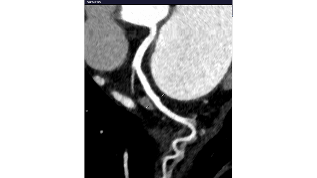 Coronary CTA at Very High Heart Rate with Very Good Image Quality