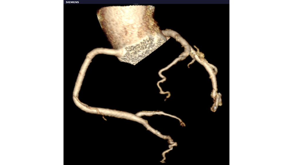 Coronary CTA at Very High Heart Rate with Very Good Image Quality