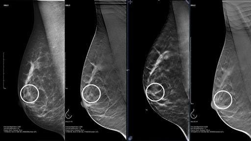 Tomo biopsy: What it's all about - Siemens Healthineers