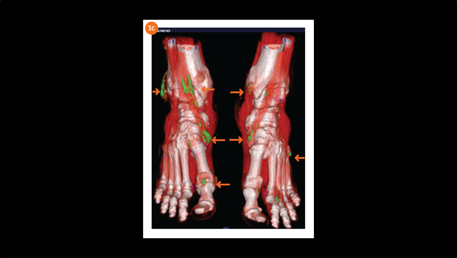 Dual-Energy CT Diagnosis of Gouty Arthritis in the Foot