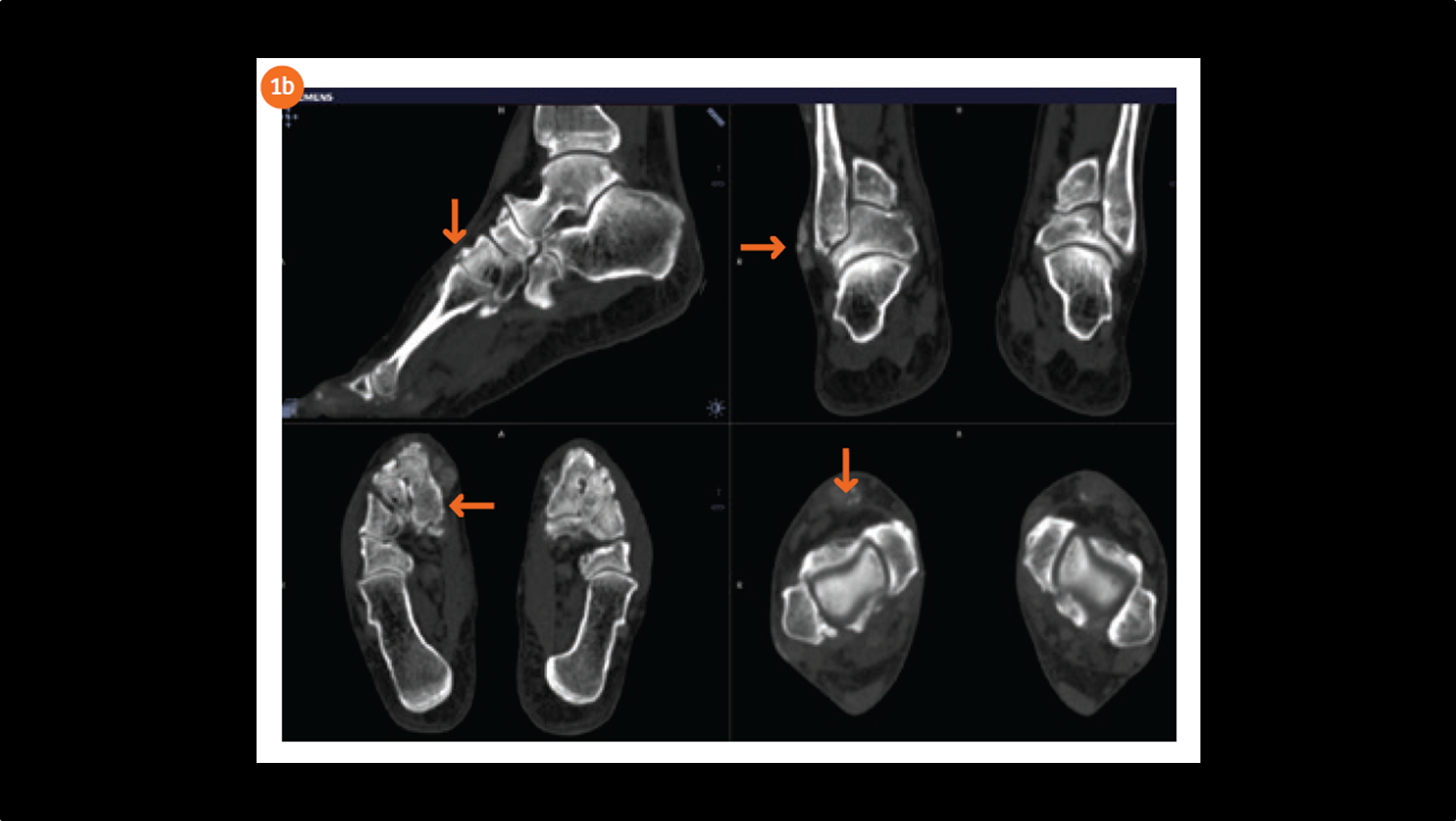 Dual-Energy CT Diagnosis of Gouty Arthritis in the Foot