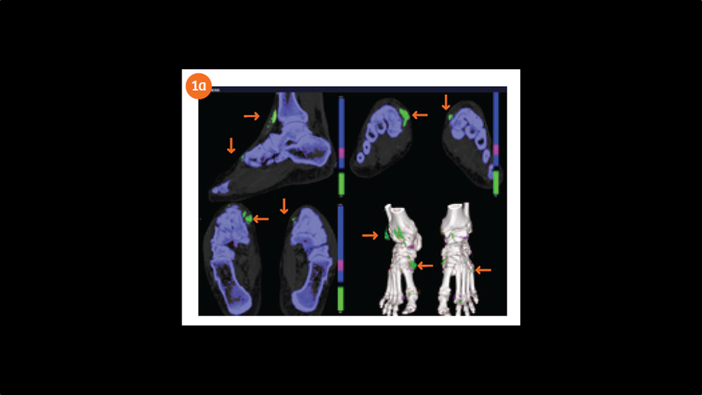 Dual-Energy CT Diagnosis of Gouty Arthritis in the Foot