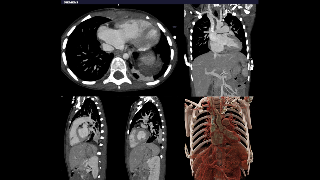 Turbo Flash - A Novel Approach in Congenital Anomaly Evaluation Imaging ...