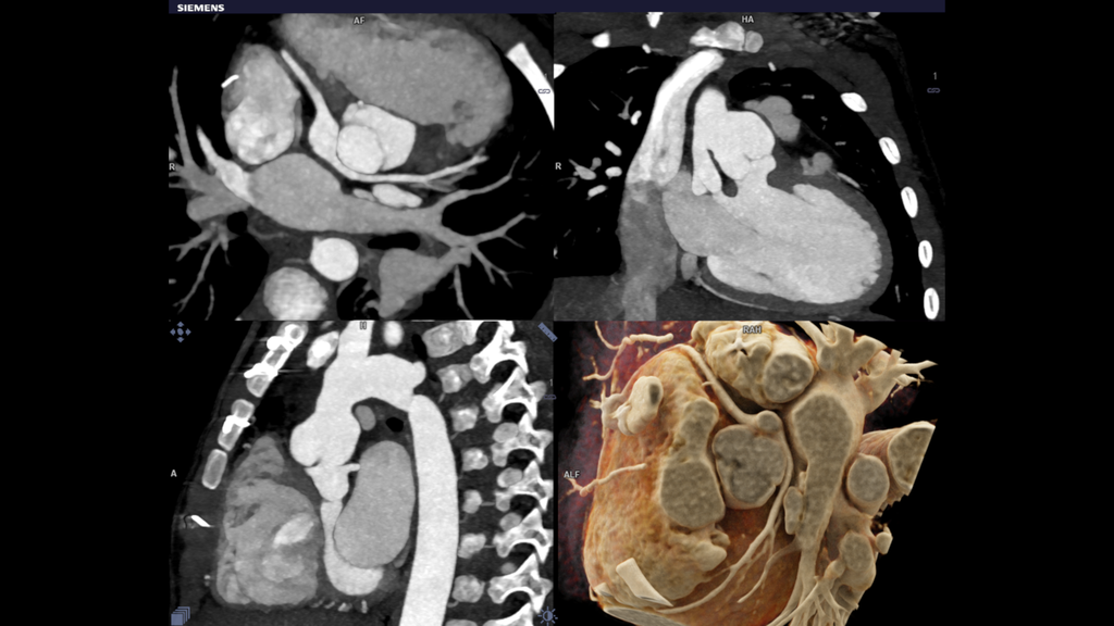 Turbo Flash - A Novel Approach in Congenital Anomaly Evaluation Imaging ...