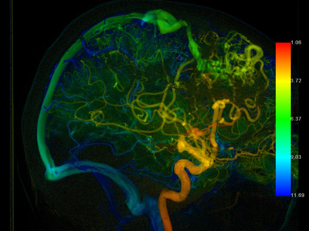 Neuroradiology - Siemens Healthineers Vietnam