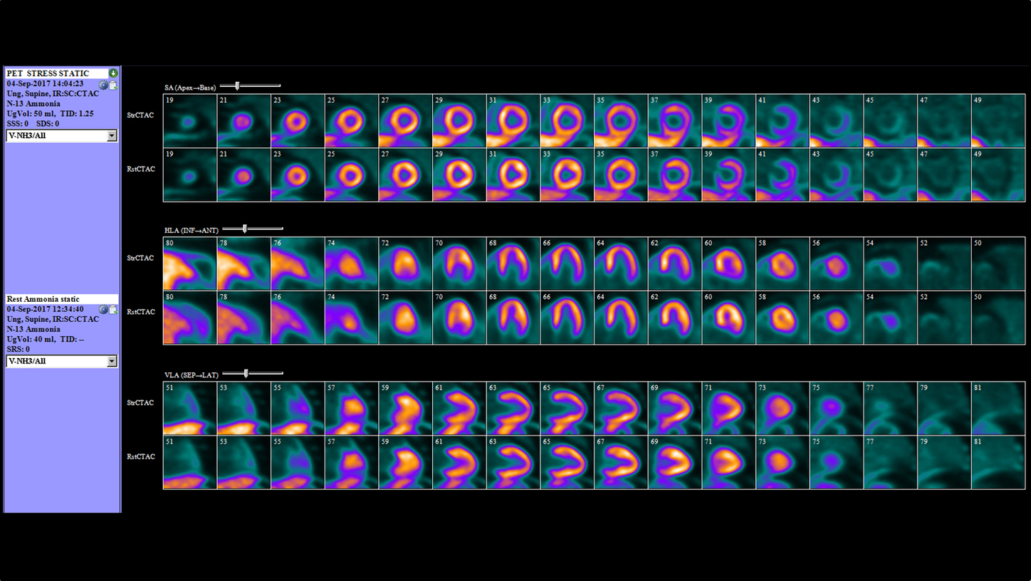 Quantification of Absolute Flow and Flow Reserve (CFR)-syngo.PET Myocardial Blood Flow