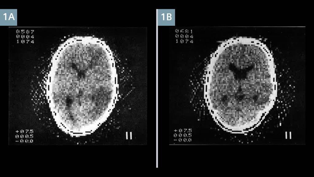 A Journey through the History of Computed Tomography – Part one: Get a ...