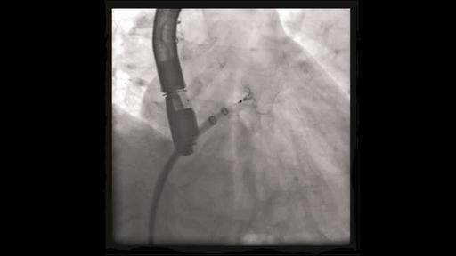 Imaging Support from 3D TEE in Left Atrial Appendage Closures - Siemens ...