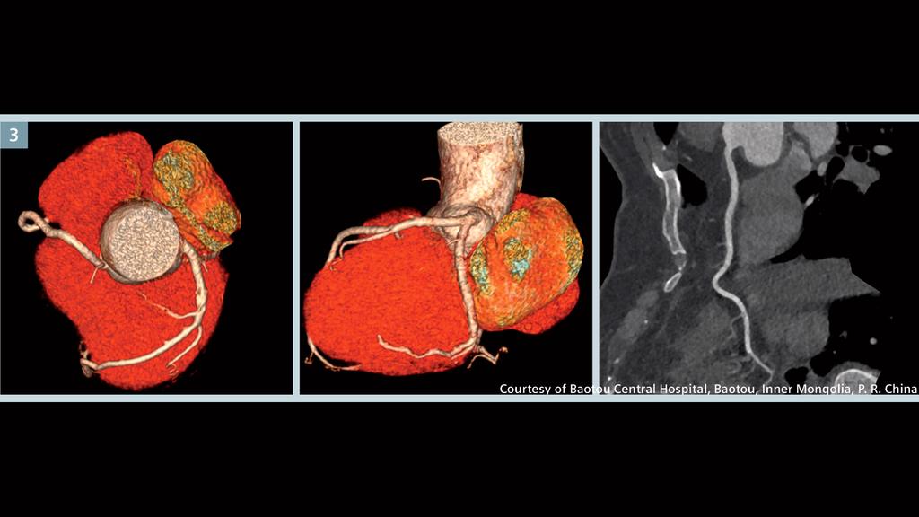 Back to the Future: 10 Years of Dual Source CT - Siemens Healthineers