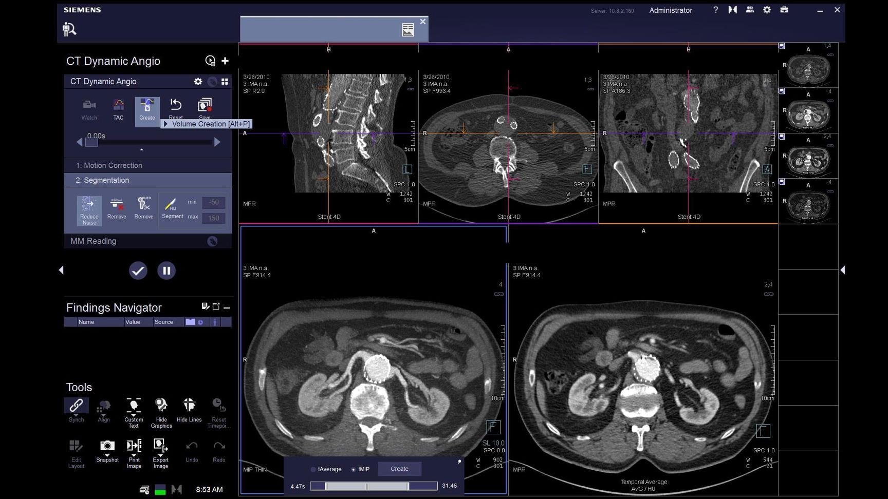 Tips & Tricks: Creating Volumes with CT Dynamic Angio