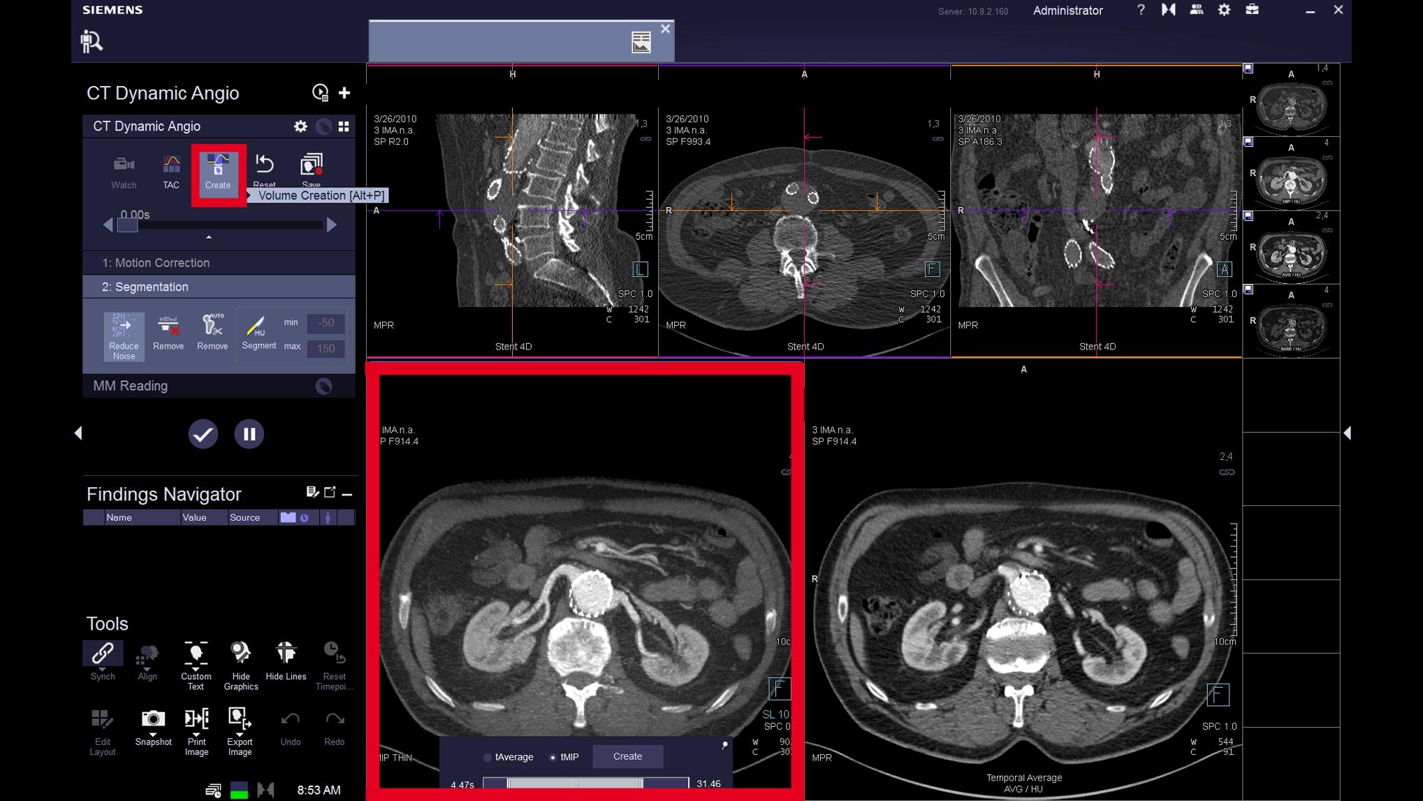 Tips & Tricks: Creating Volumes with CT Dynamic Angio